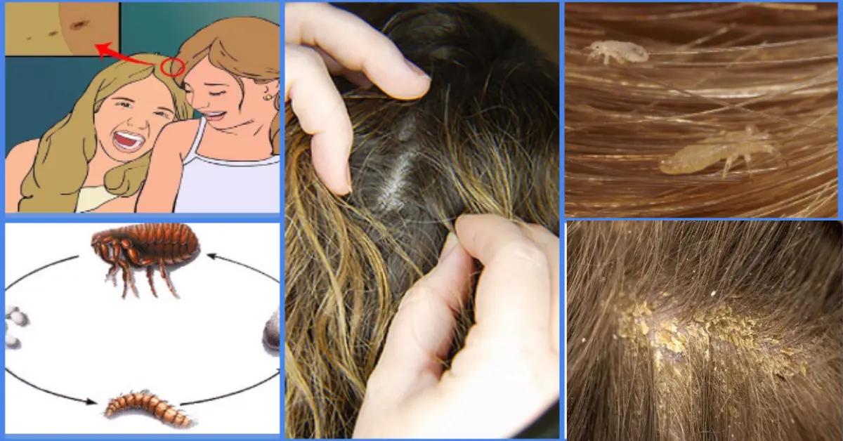 Dreaming About Bugs In Hair - Dream Cano